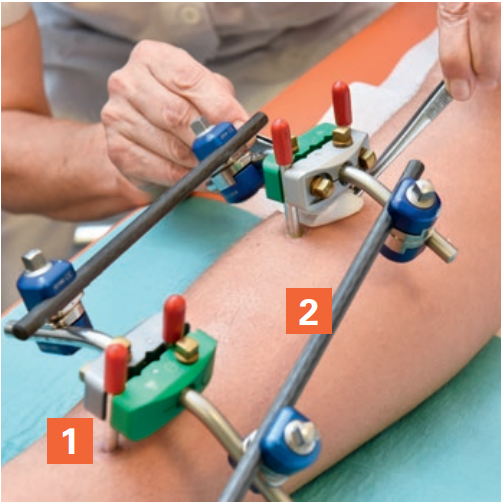 Fixateur externe - Orthopédie et traumatologie pédiatriques | HUG - Hôpitaux Universitaires de ...